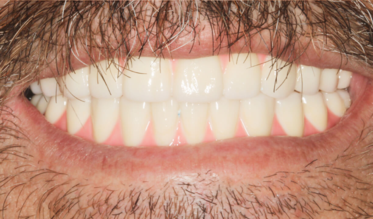 Before & After Smile Gallery | Tkatch Dentistry NC