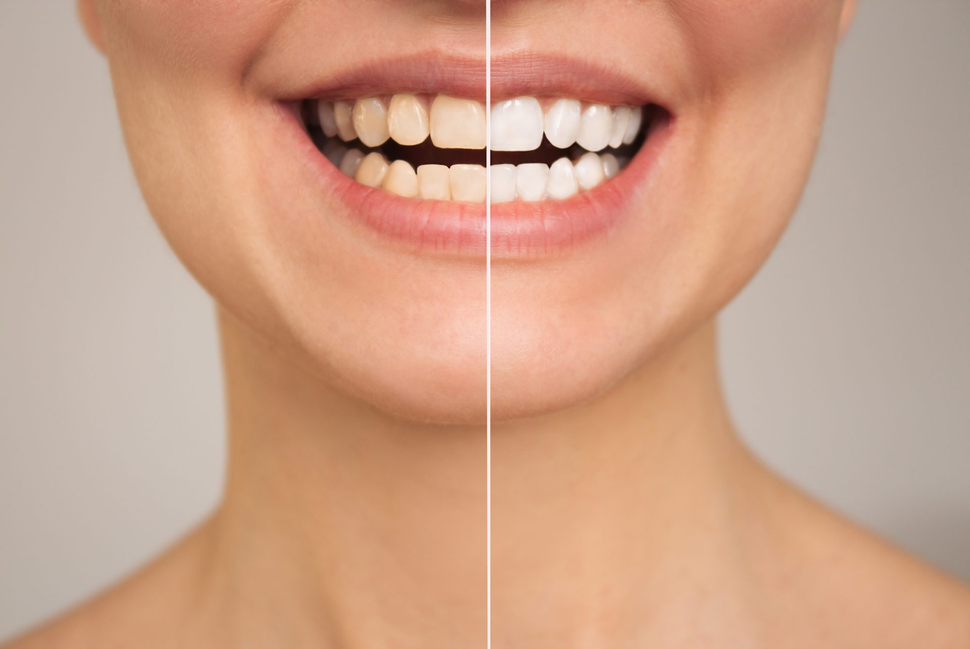 Understanding Teeth Whitening Options: Insights from a Dentist | Tkatch